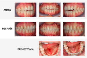 Frenectomía: ¿Qué es y cuándo se realiza? – MVP Dental Móstoles y Getafe